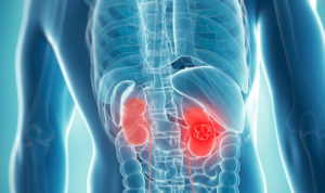 Leibovich score - Action Kidney Cancer