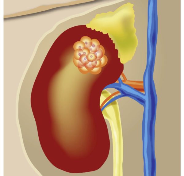 Leibovich score - Action Kidney Cancer
