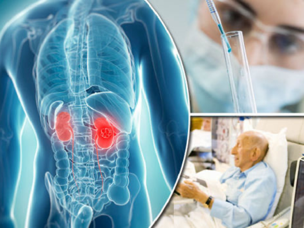 Leibovich score - Action Kidney Cancer